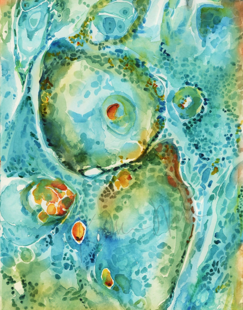 Basal Cell Carcinoma Watercolor Print | Cancer Art – Lyon Road Art